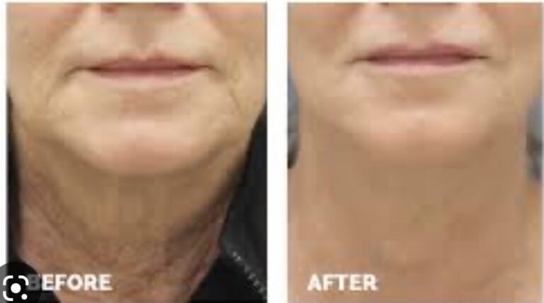 Pixel 8 Radiofrequency Microneedling: Costs, Safety and Side Effects